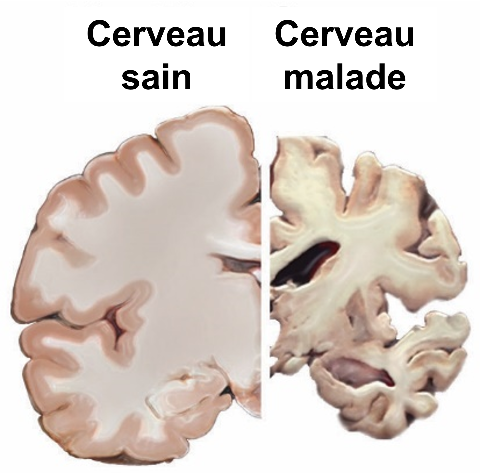 Cerveau et maladie d'Alzheimer | Planet-Vie